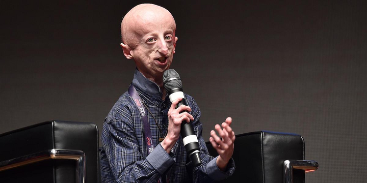 Understanding Progeria (Hutchinson-Gilford Syndrome): Causes, Symptoms ...